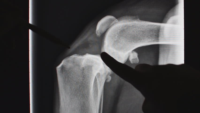 Veterinarian Explaining Radiograph To A Pet Owner. Dog Suffers From A ...